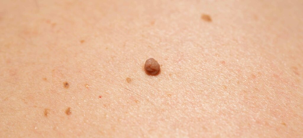 Comment se débarrasser de ses acrochordons, verrues séborrhéiques et ...