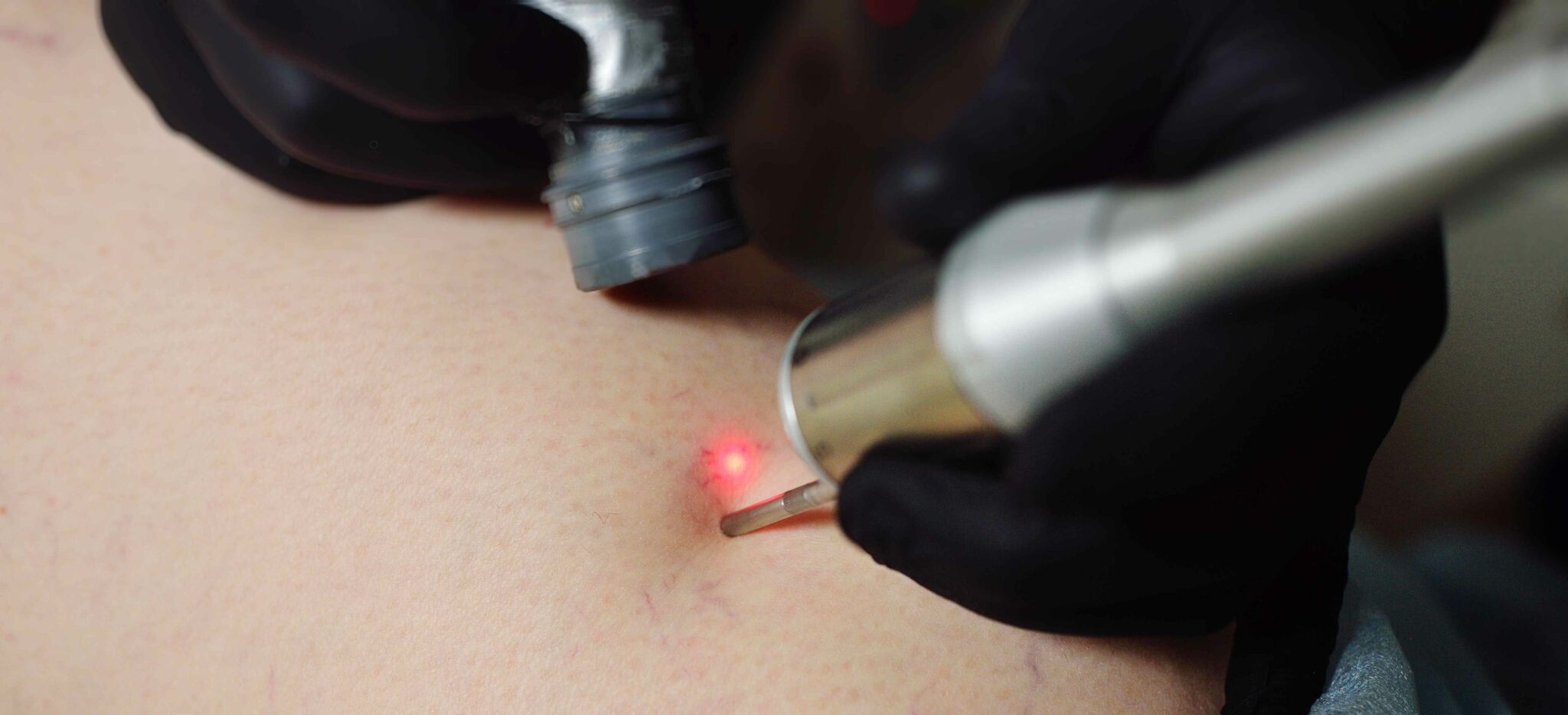 IPL : Quels sont les avantages de cet appareil 3 en 1 ? | Dr Mayeux | Paris