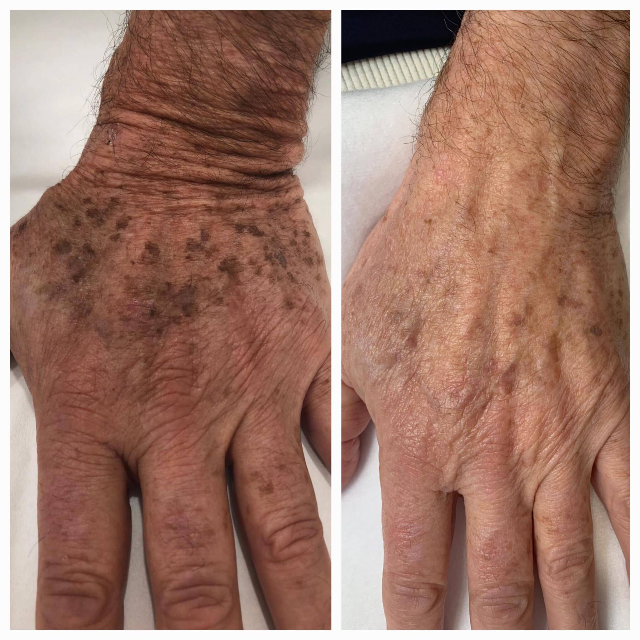 En quoi consiste le traitement par IPL en médecine esthétique ? | Dr ...