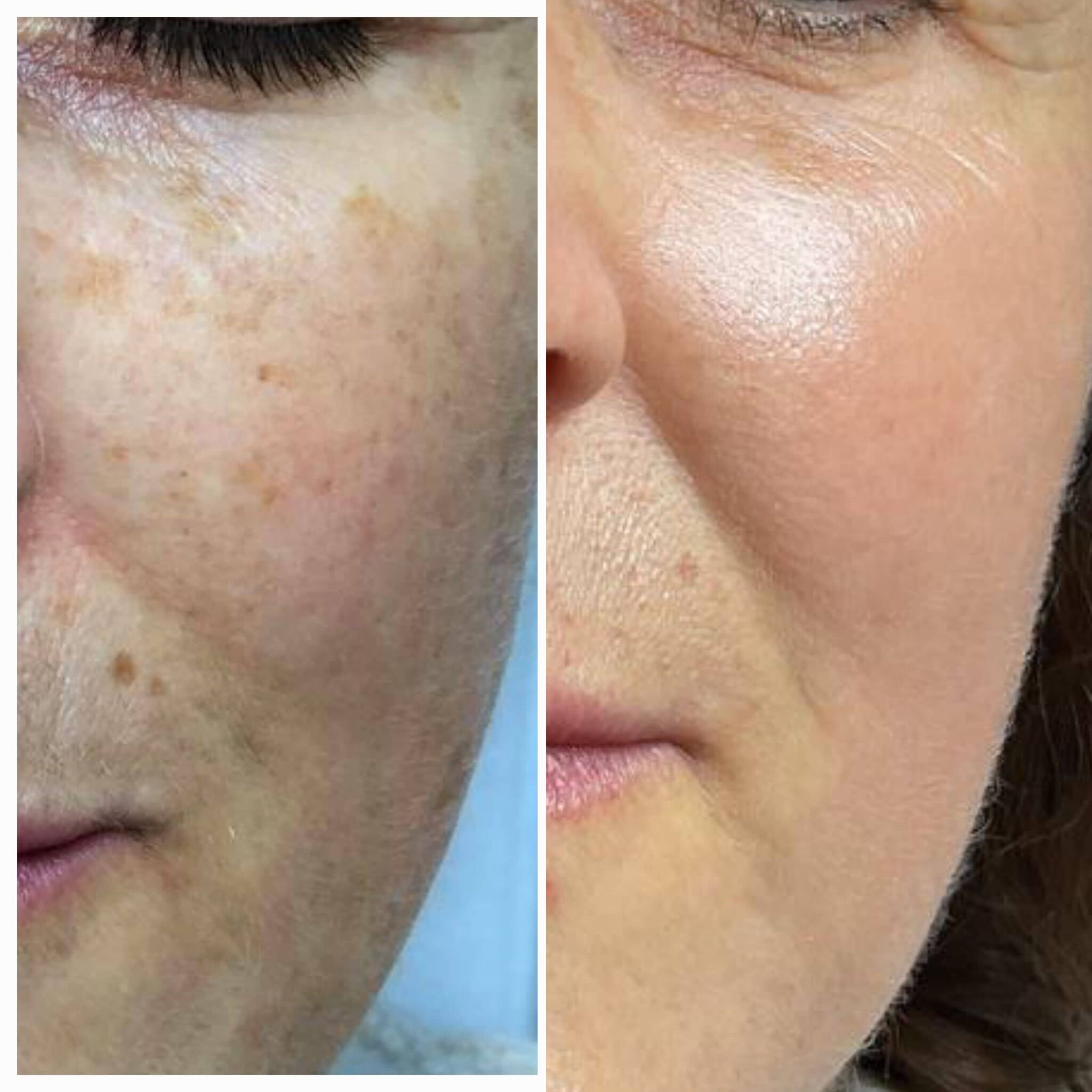 En quoi consiste le traitement par IPL en médecine esthétique ? | Dr ...