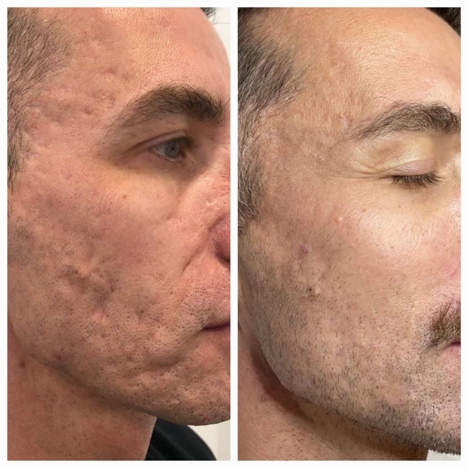 Quels sont les meilleurs traitements contre les cicatrices d'acné ...